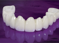 Porcelain Bridges - Timothy P. Resuta DMD & Associates